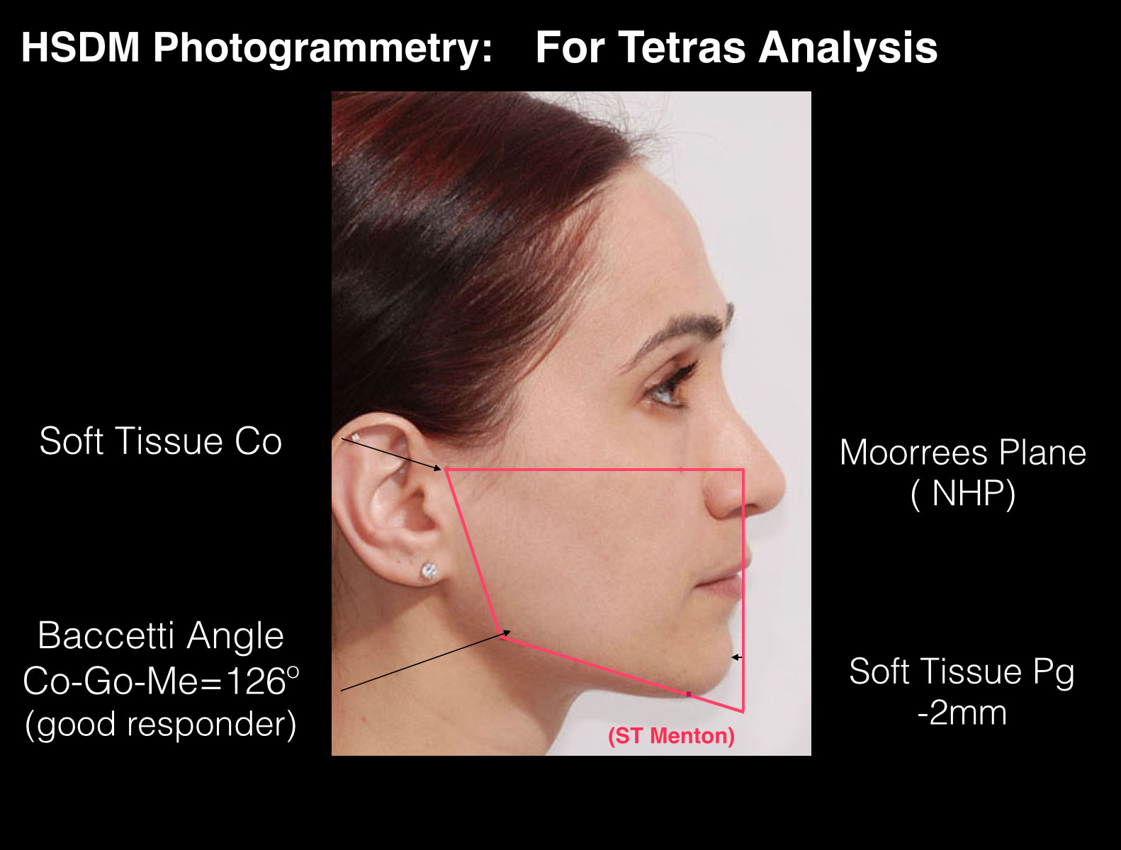 Photogrammetry Tetrahedron 3D (Wedge) Analysis: Tetras Profile ...