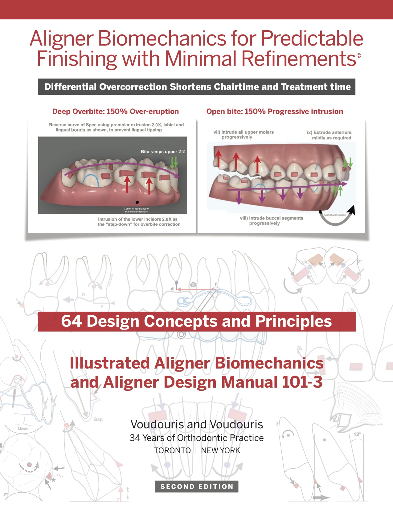 Aligner Biomechanics Guide-book Toronto ON, Innovative Orthodontics